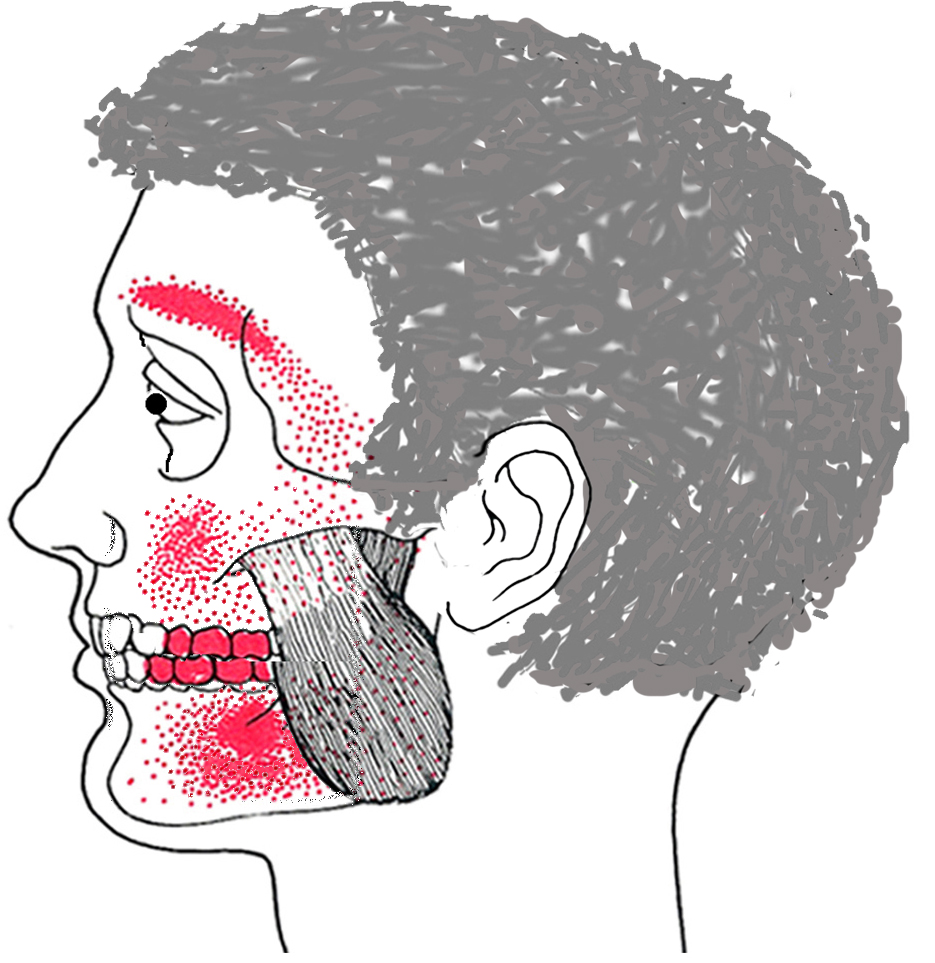 Masseter_external_smerte_total - Zone44