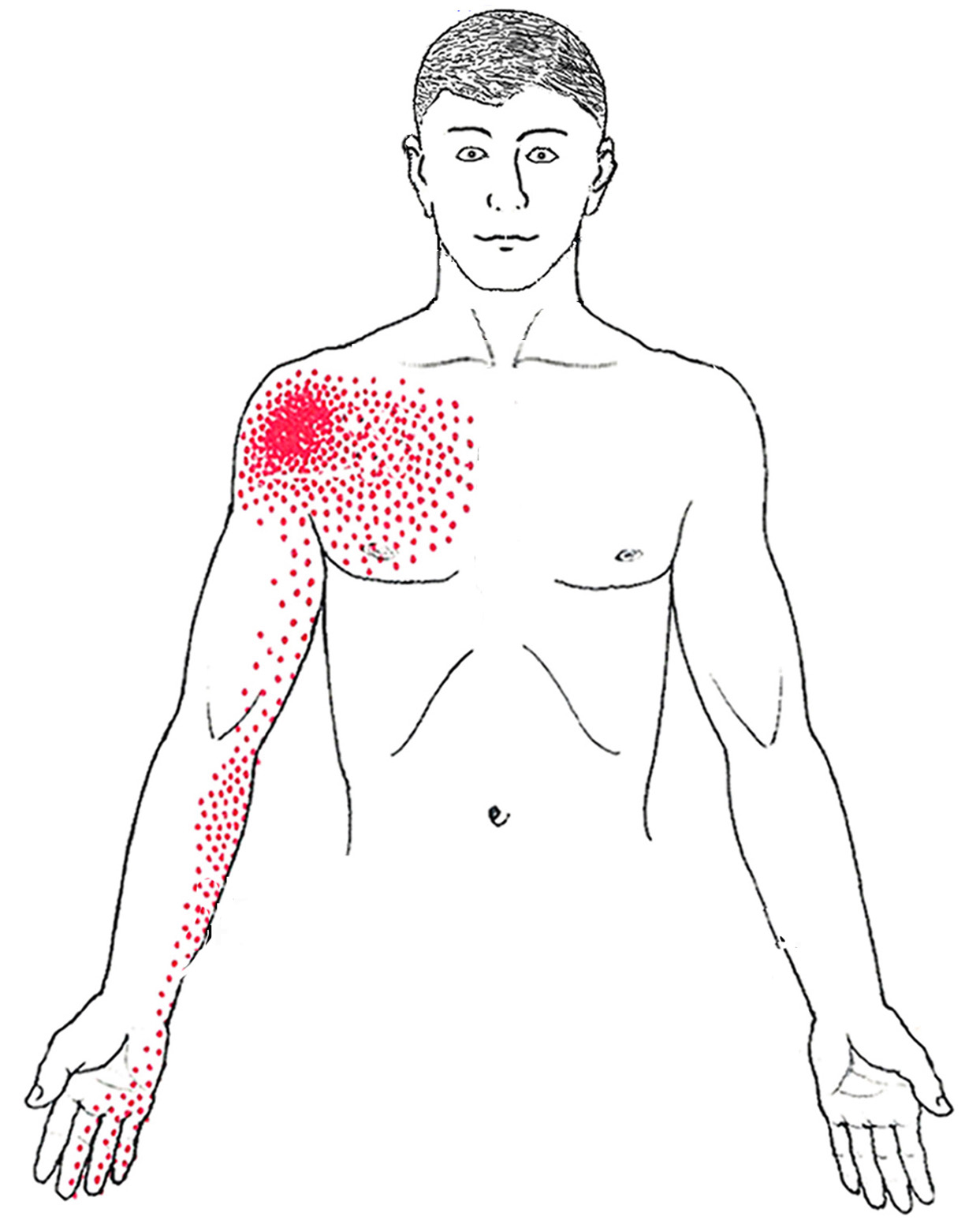 Brystkasse - brystsmerter - zoneterapi