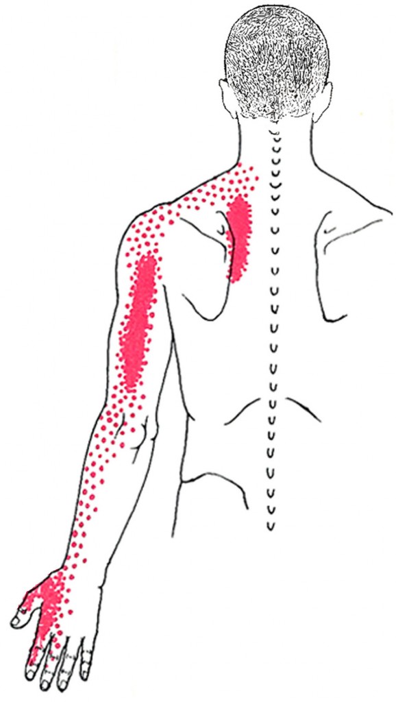 Scaleni - zoneterapi