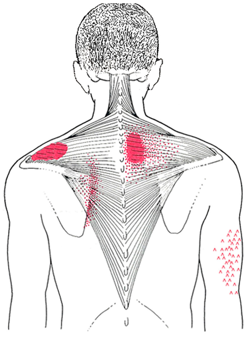 Trapezius medius - Trapezius inferior - skulder - zoneterapi