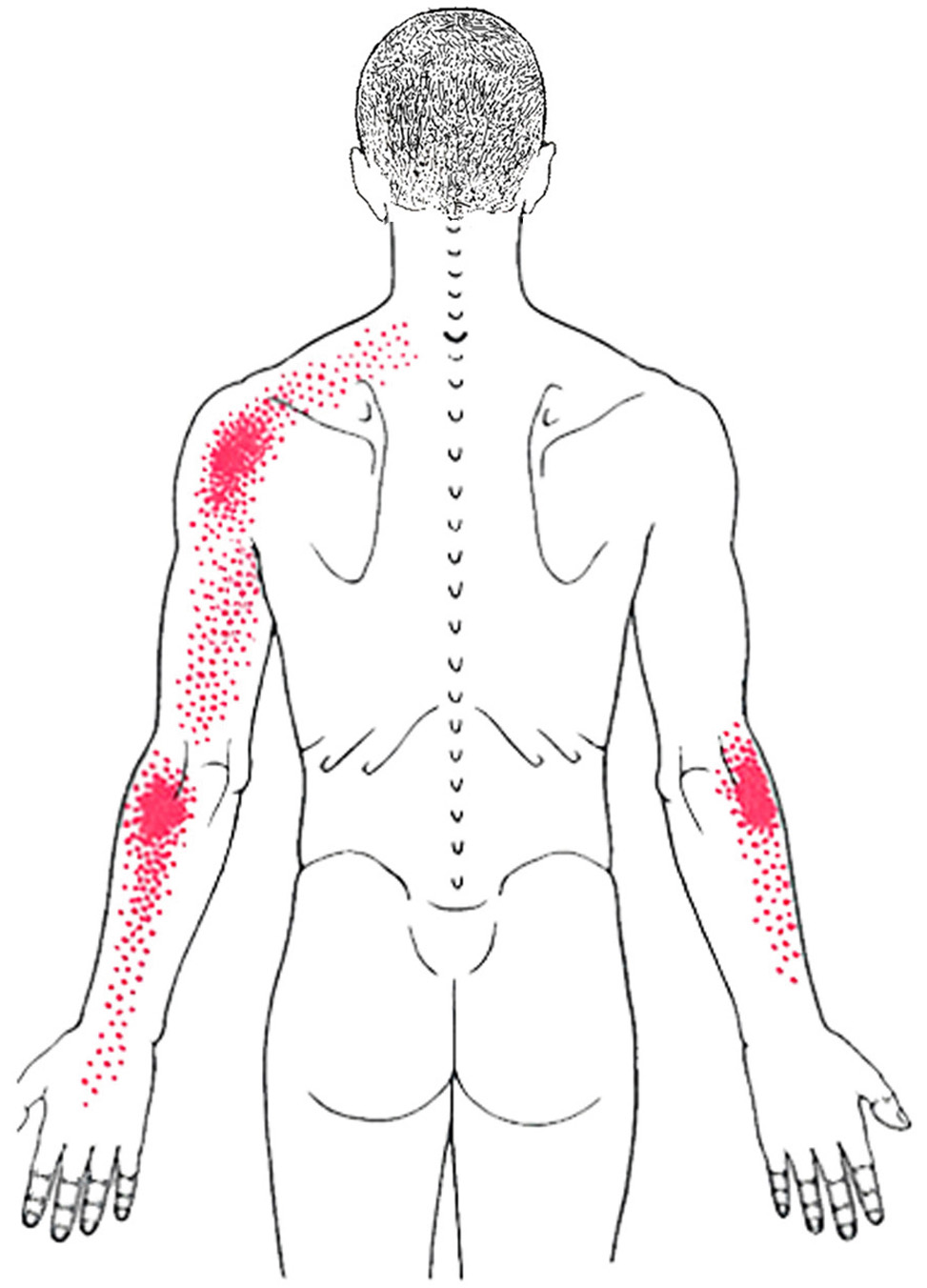 Albue - musearm - tennisalbue - golfarm - zoneterapi